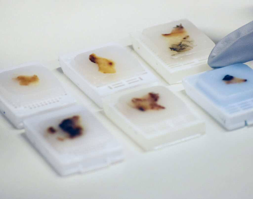 CLDN18.2 Positive & Negative FFPE Tissue Samples | Discovery Life Sciences